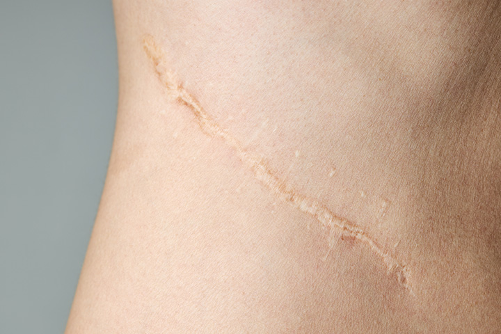What kind of accidents cause scarring and disfigurement? - Edwards ...